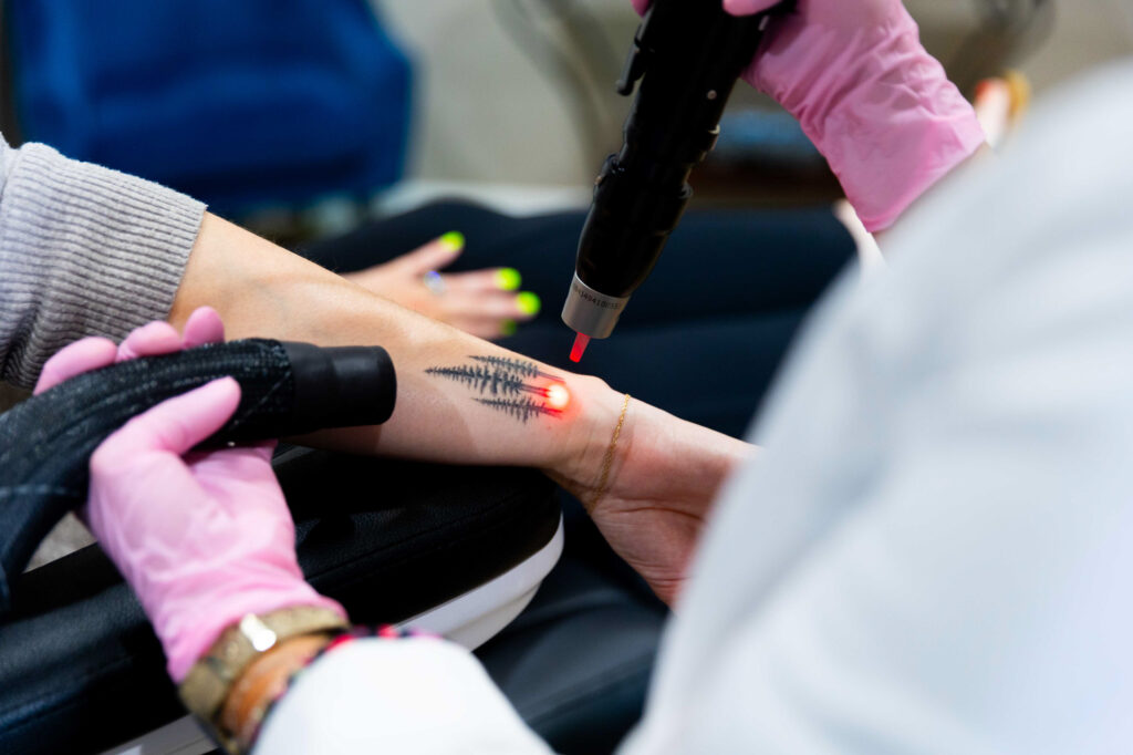 Tattoo Removal | Peninsula Glow
